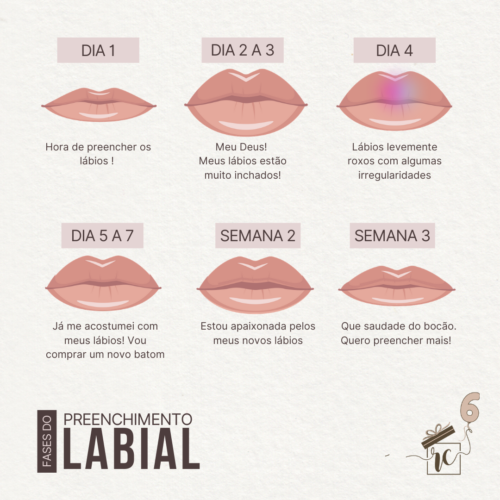 FASES DO PREENCHIMENTO LABIAL - Rubia de Carli FASES DO PREENCHIMENTO LABIAL - Rubia de Carli